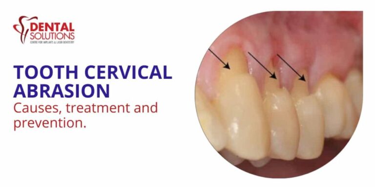 Tooth Cervical Abrasion: Causes, Treatment & Prevention