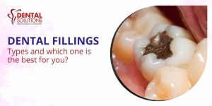 Types of Dental Fillings | Tooth Restoration Guide