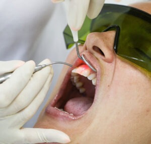 Laser assisted Root Canal Treatment - laser RCT