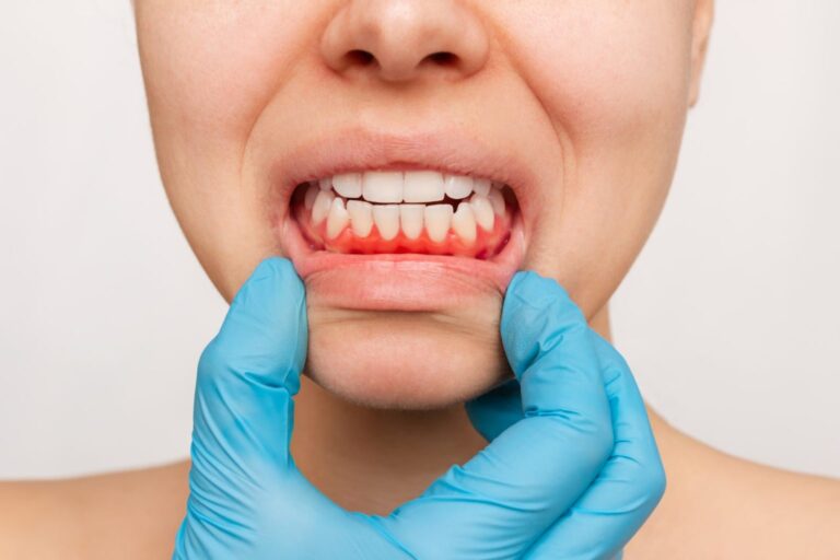 Bleeding Gums Treatment in Bangalore | Laser Gum Surgery in Bangalore ...