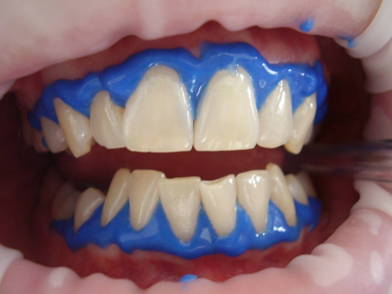 Fluoride Treatment: Benefits & Side Effects Dental Solutions Bangalore